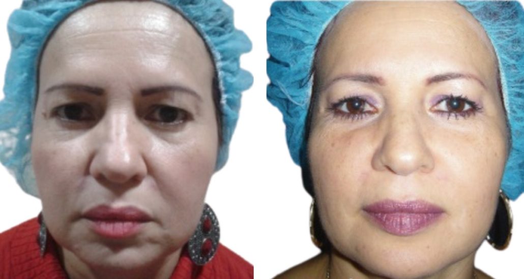 Exilis Rostro | Clínica Estética Carvajal