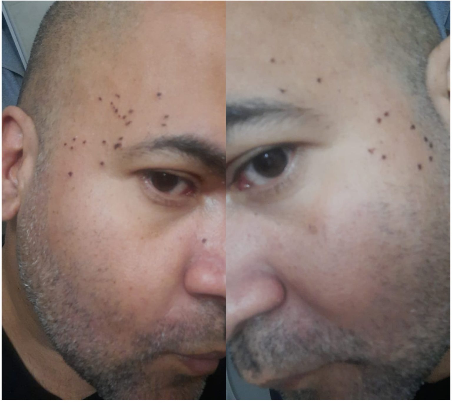 Cauterización | Clínica Estética Carvajal