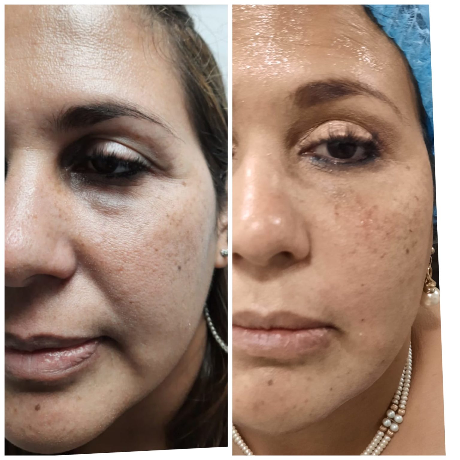 Total Lift | Clínica Estética Carvajal