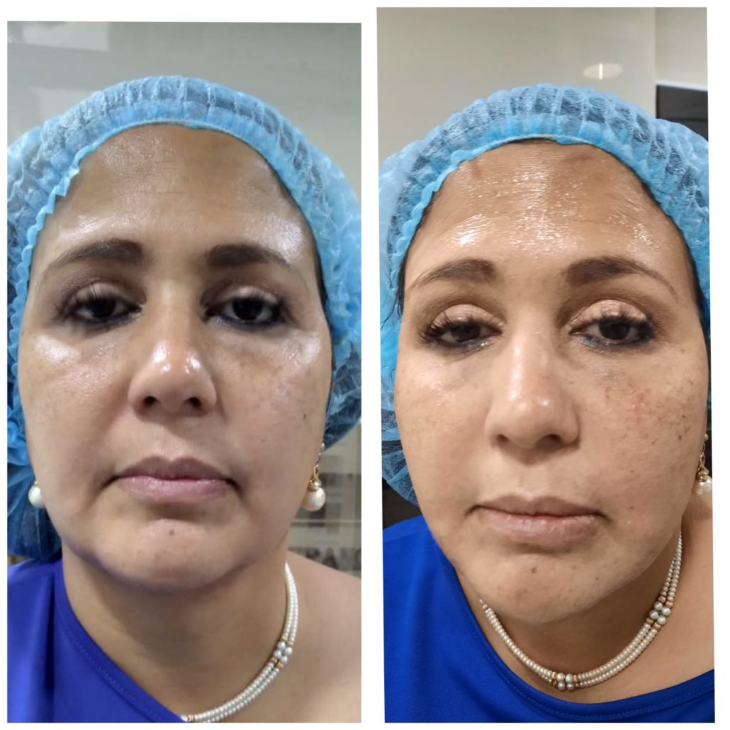 Total Lift | Clínica Estética Carvajal