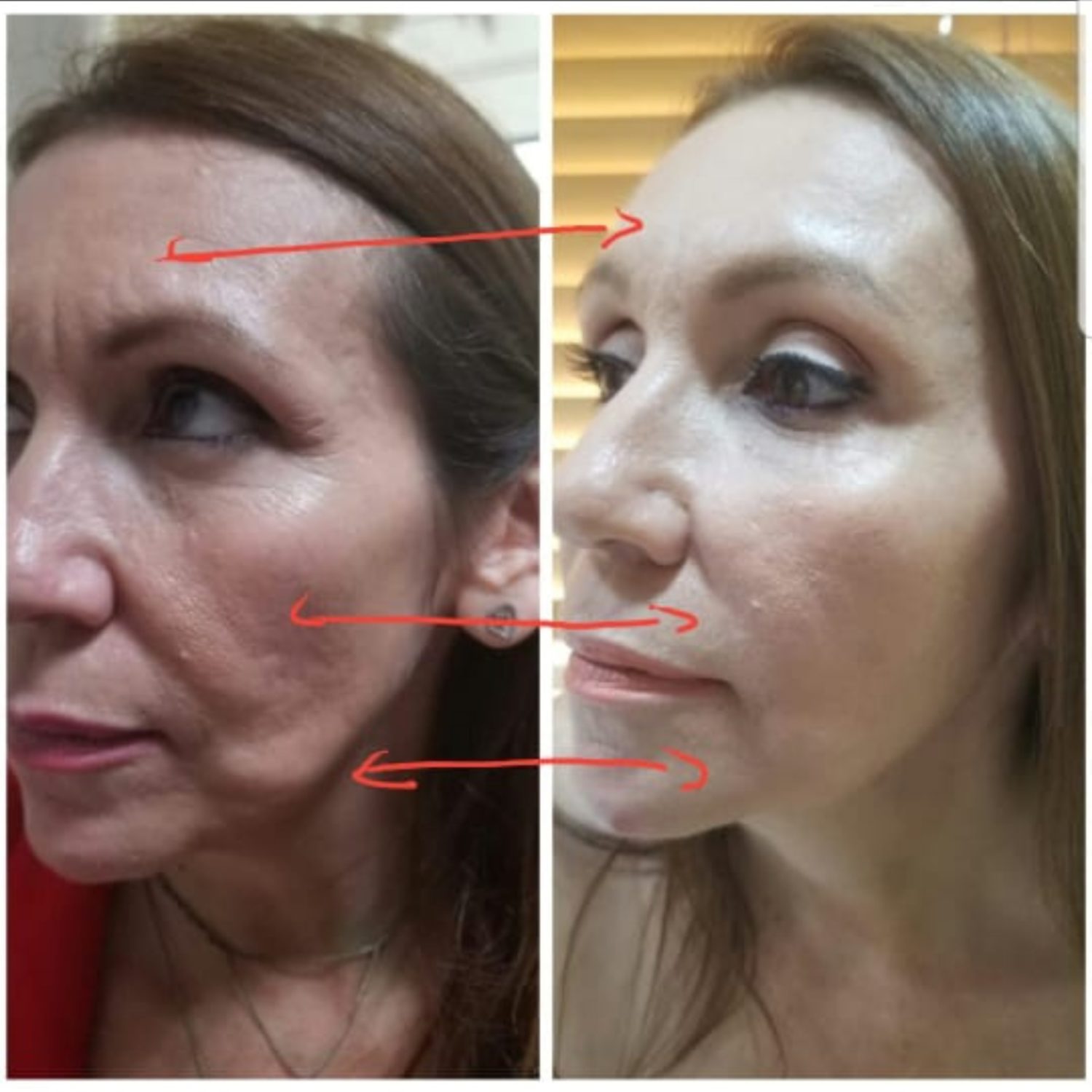 HIFU Rostro y Cuello | Clínica Estética Carvajal