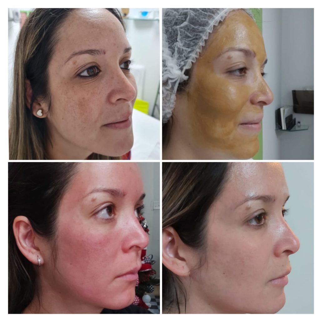 Cosmelan | Clínica Estética Carvajal