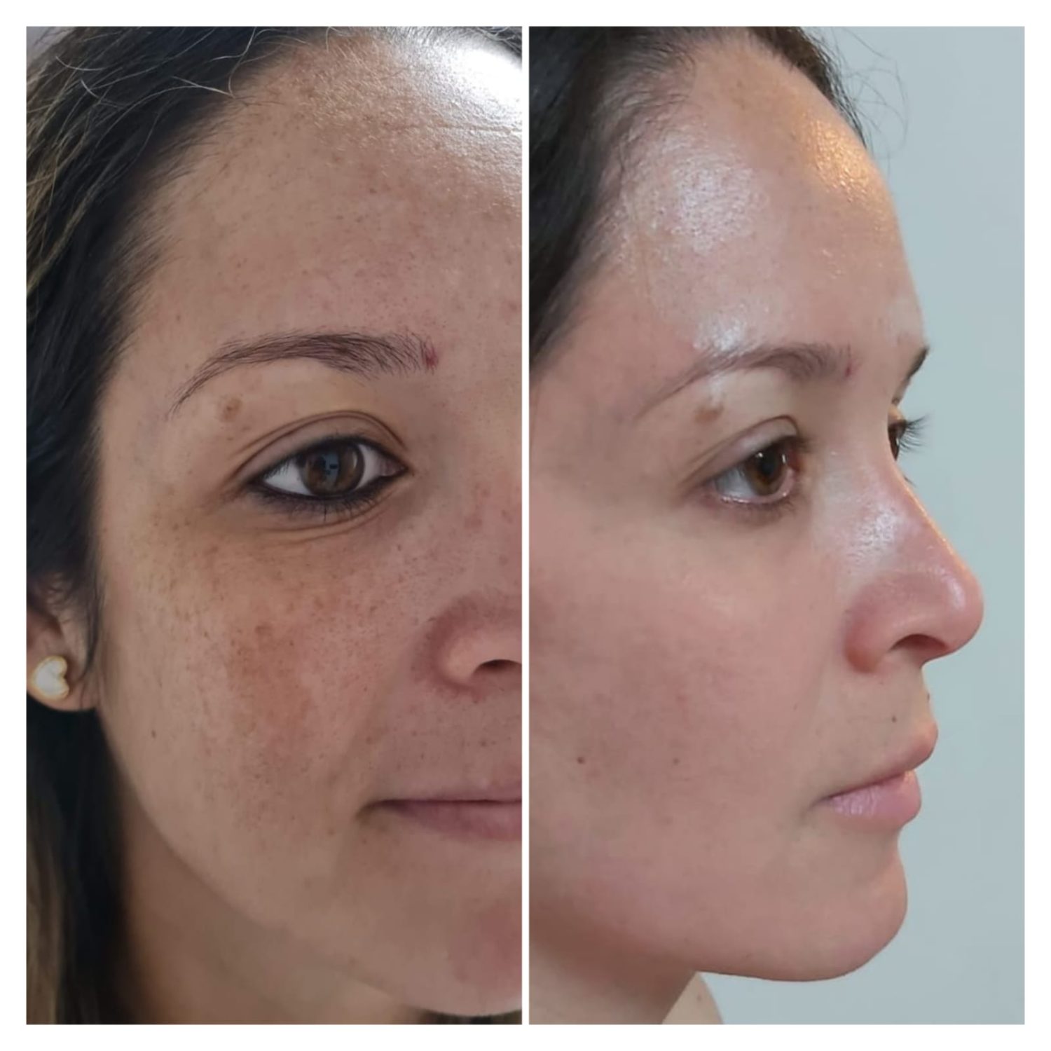 Cosmelan | Clínica Estética Carvajal
