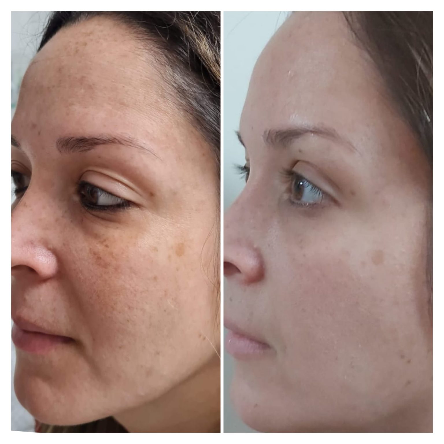 Cosmelan | Clínica Estética Carvajal