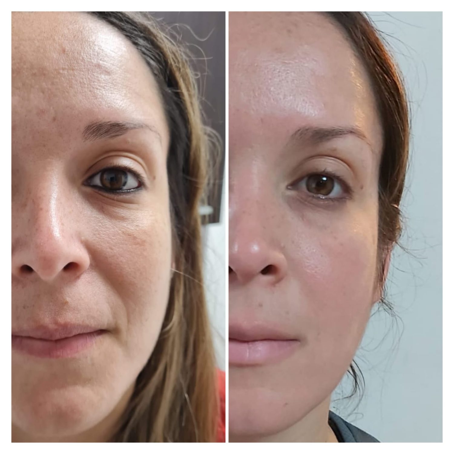 Cosmelan | Clínica Estética Carvajal