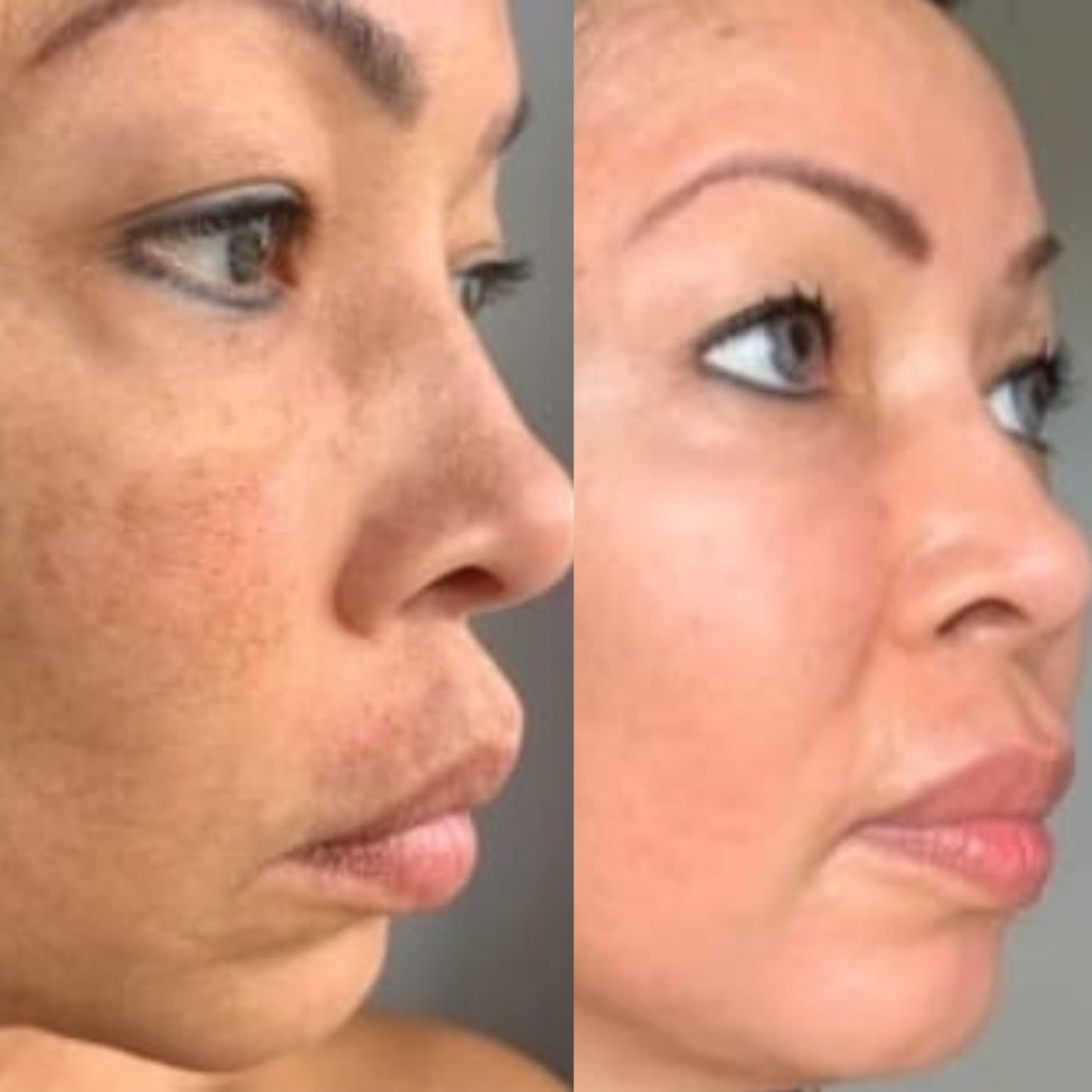 Cosmelan | Clínica Estética Carvajal