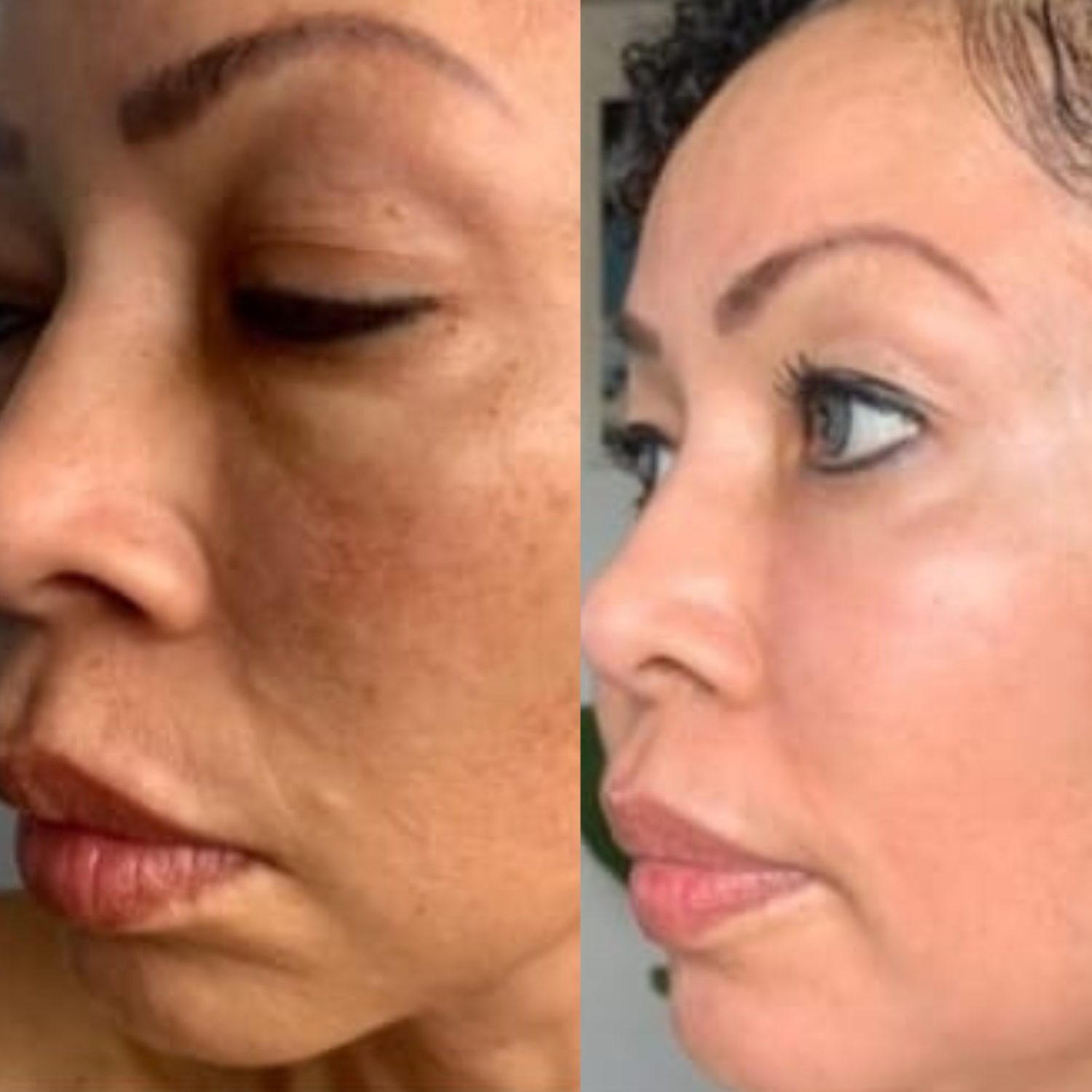 Cosmelan | Clínica Estética Carvajal